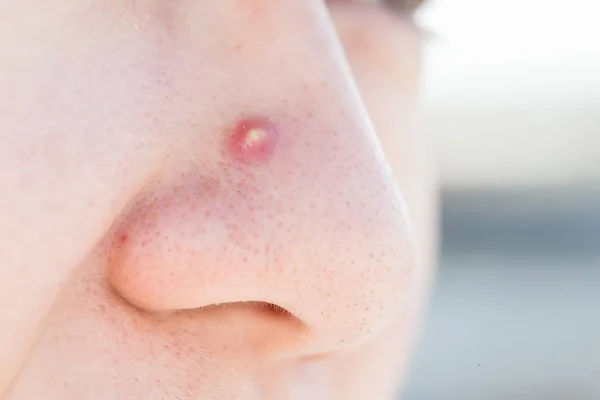 Unsure About A Nose Bump? Ask A Dermatologist A Question.